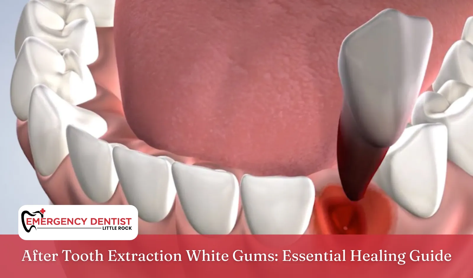 After Tooth Extraction White Gums: Essential Healing Guide