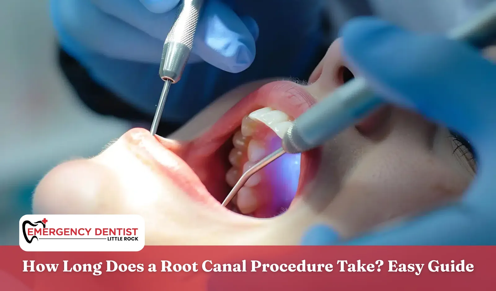 How Long Does a Root Canal Procedure Take? Easy Guide