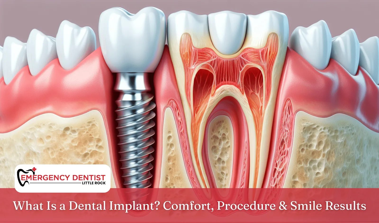 What Is a Dental Implant? Comfort, Procedure & Smile Results