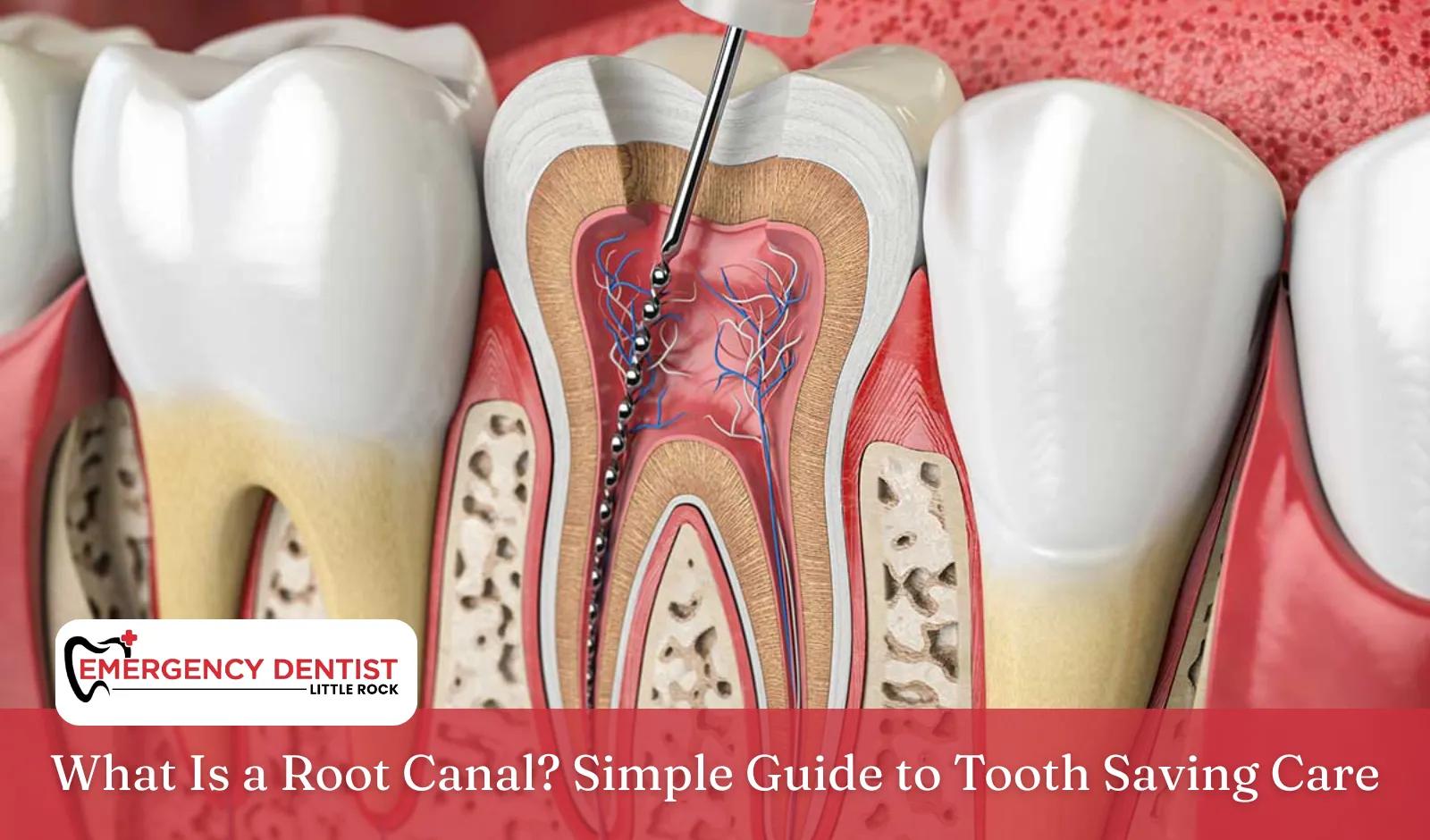 What Is a Root Canal? Simple Guide to Tooth Saving Care
